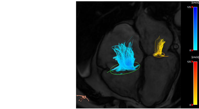 4D Flow derived mitral regurgitation methods :: Pie medical imaging